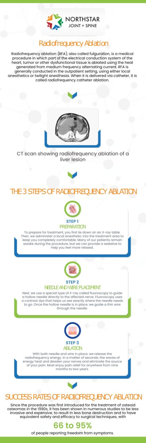 Radiofrequency Ablation (RFA) Treatment for Pain in Plano, TX